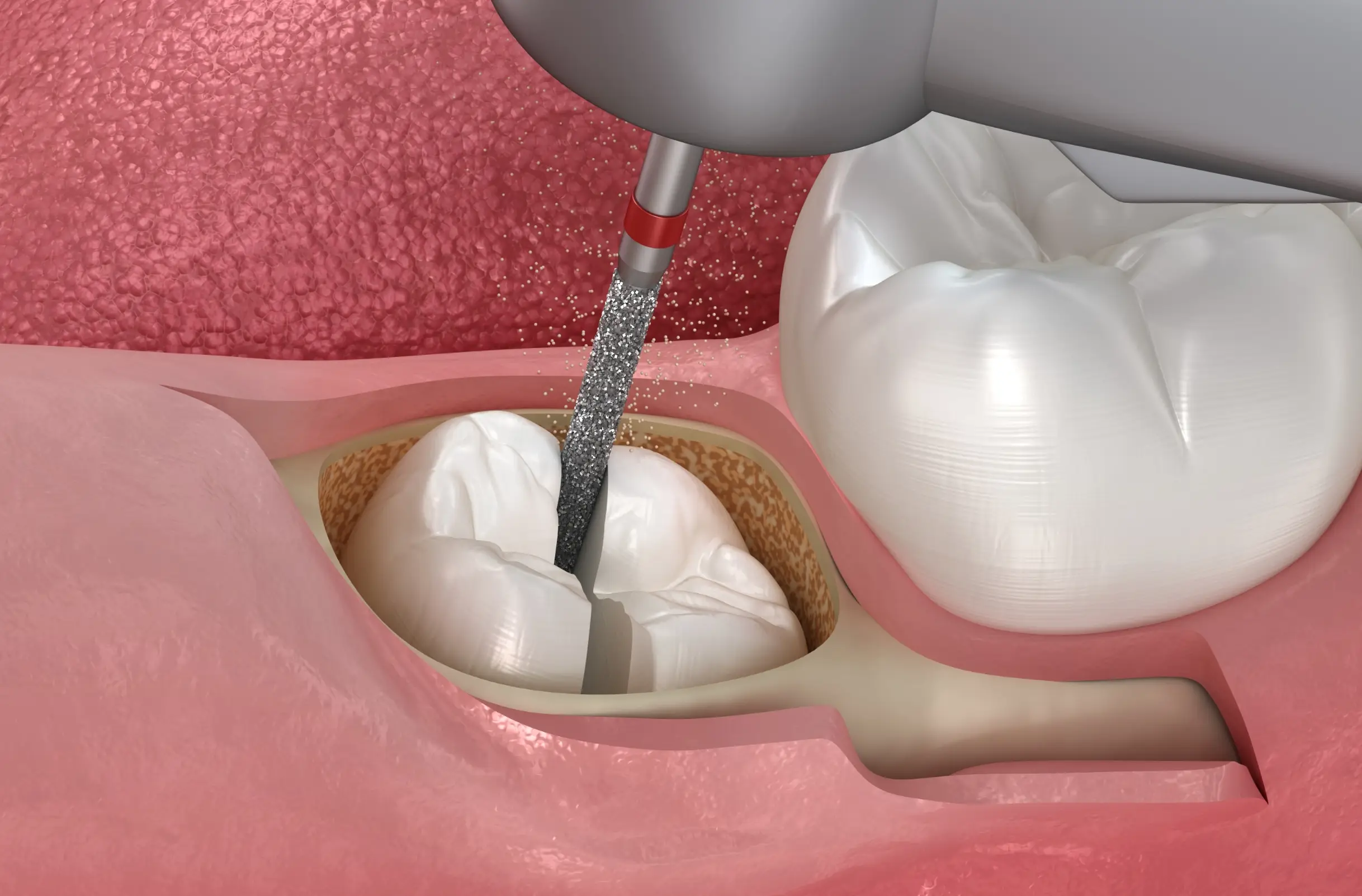 รู้ครบทุกขั้นตอนการผ่าฟันคุด ผ่าแล้วดูแลแผลยังไงให้หายไว