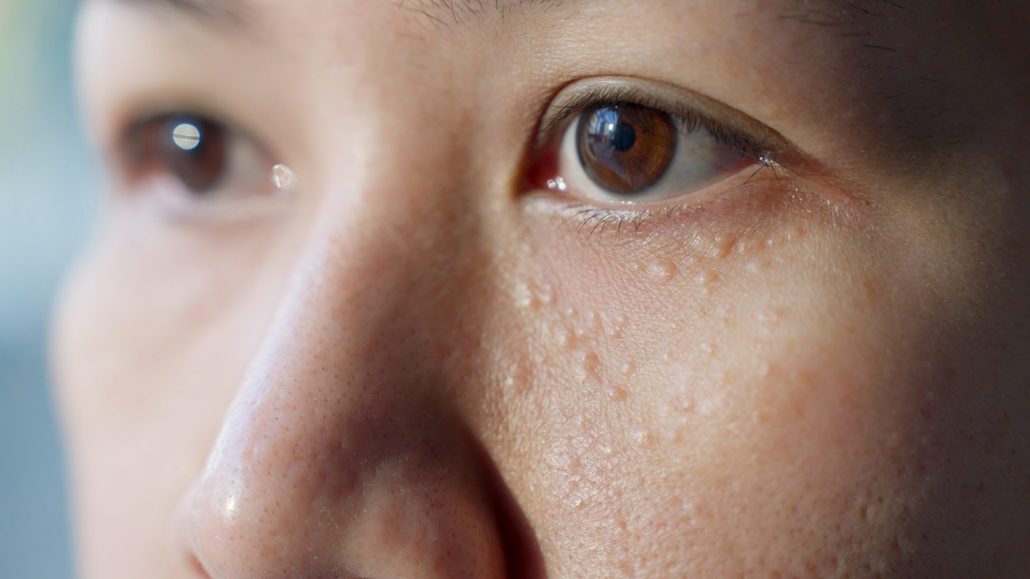 สิวหิน เกิดจากอะไร ดูแลและรักษาอย่างไรบ้าง