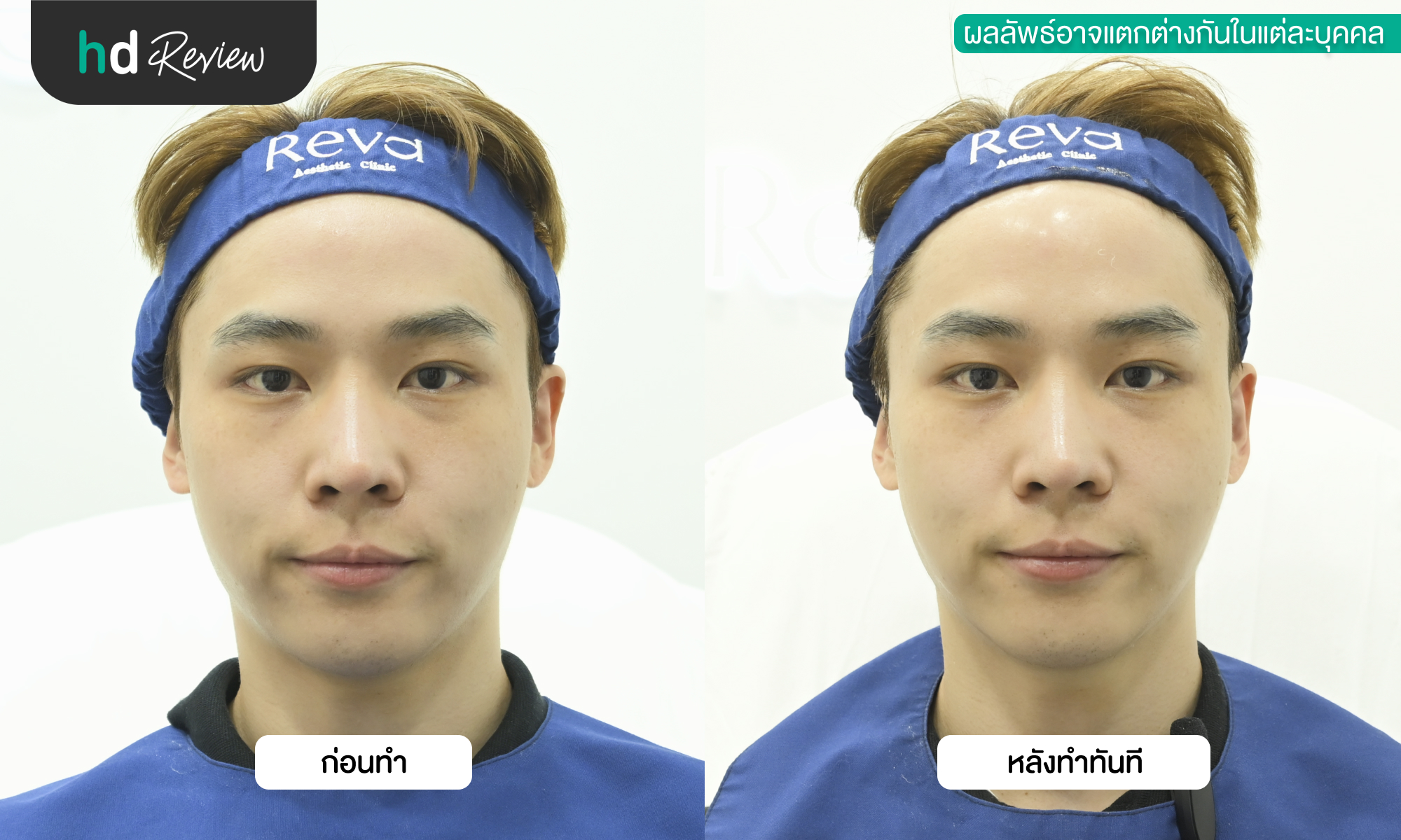 รีวิวโปรแกรม Duo ยกกระชับด้วยเครื่อง Ultraformer III และ Oligio ที่ ...