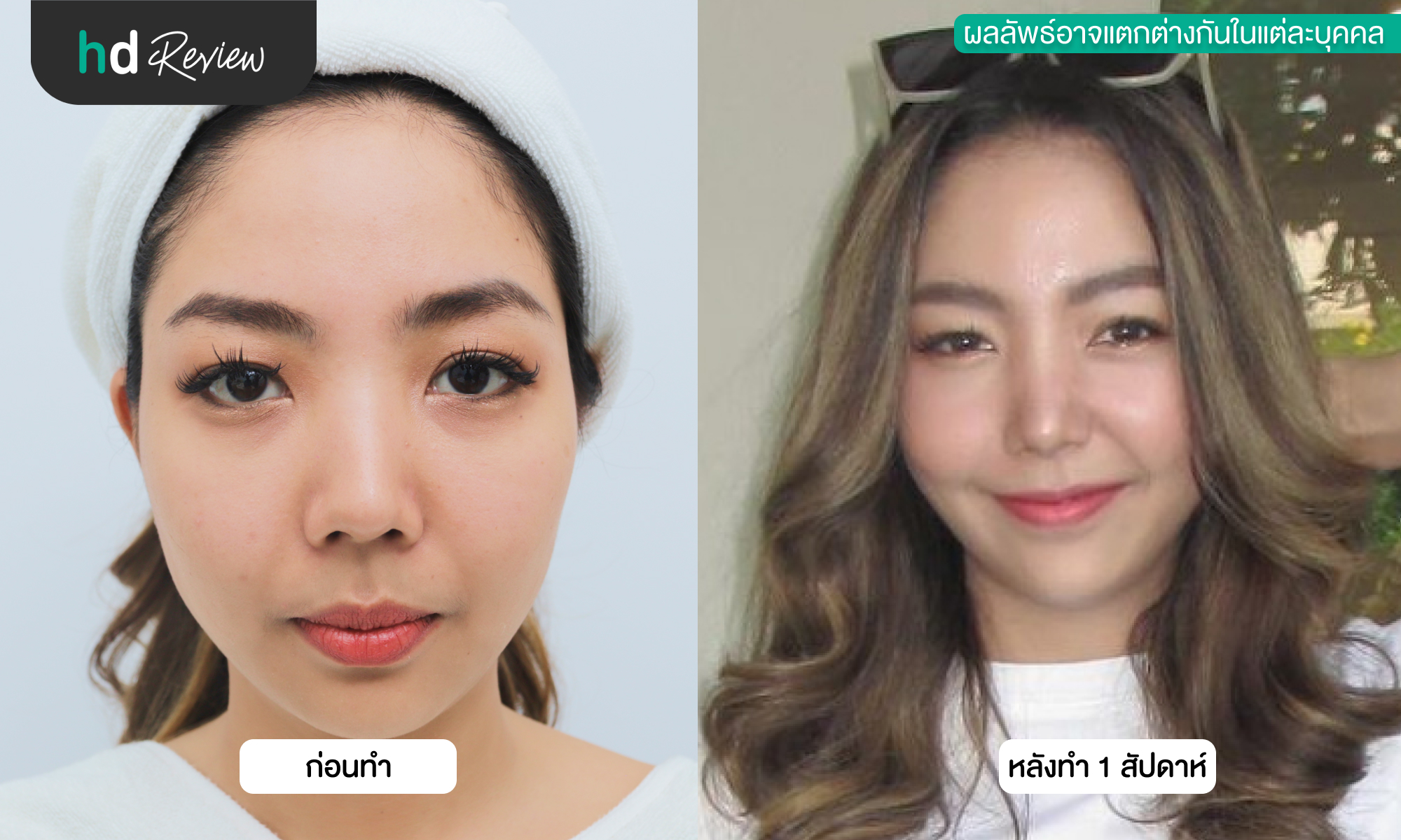 รีวิวแก้ปัญหารูขุมขนกว้าง ด้วยโปรแกรม Pico Laser และฉีด Rejuran ที่ ...