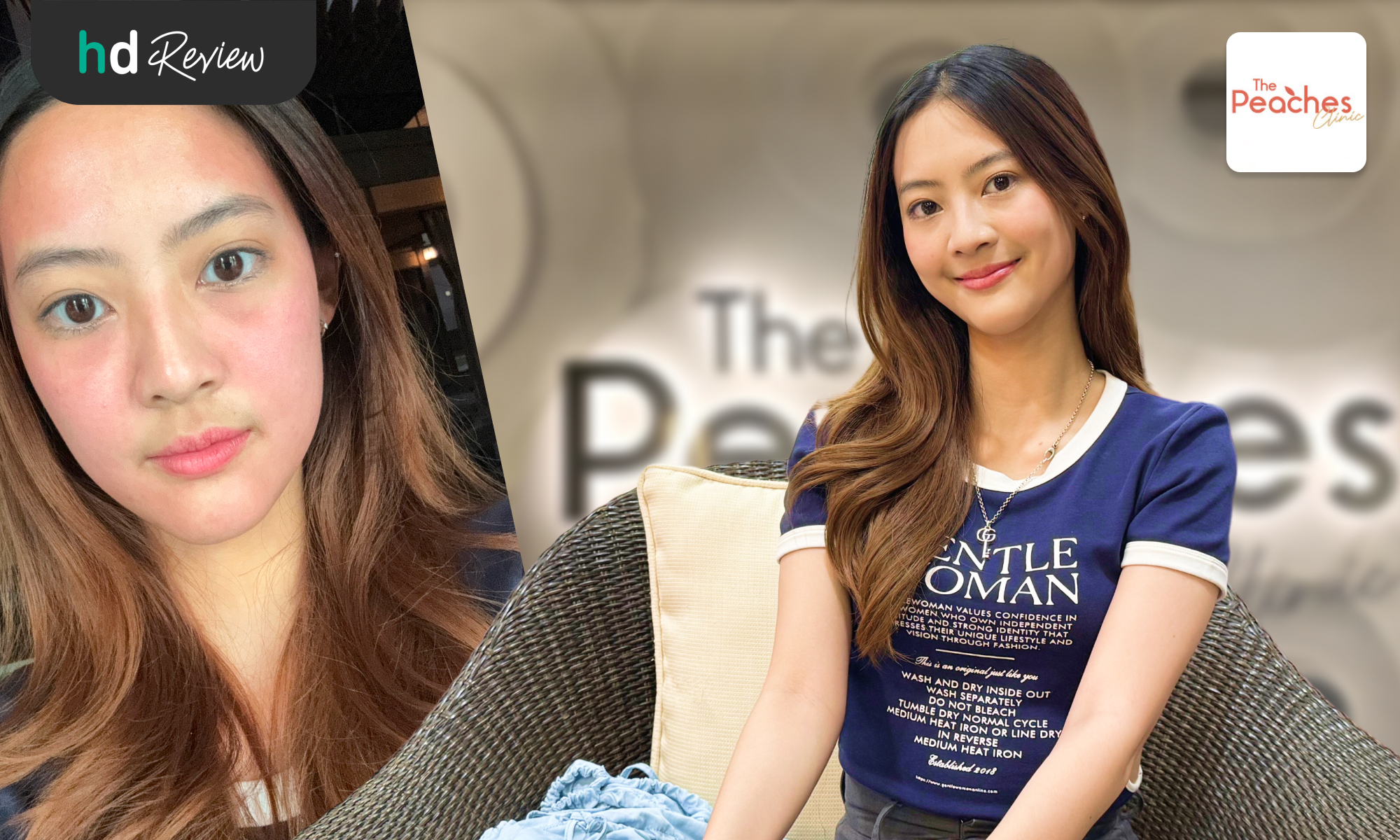 รีวิว โปรแกรม Pico Laser ฟื้นฟูผิวคล้ำ กระชับรูขุมขน ที่ The Peaches Clinic