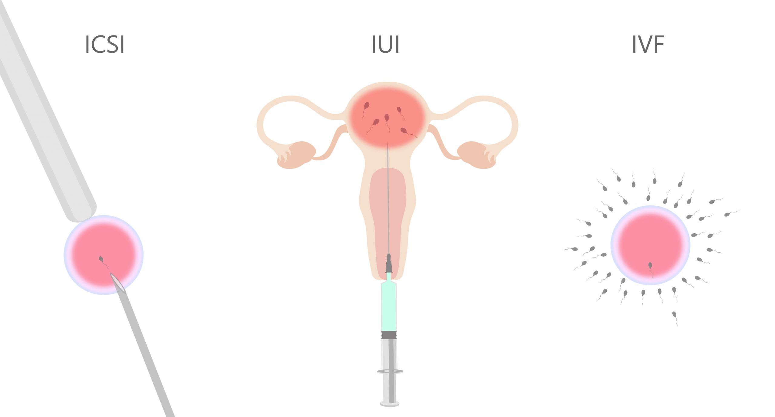 IUI คืออะไร เลือกเพศได้ไหม ราคาเท่าไร