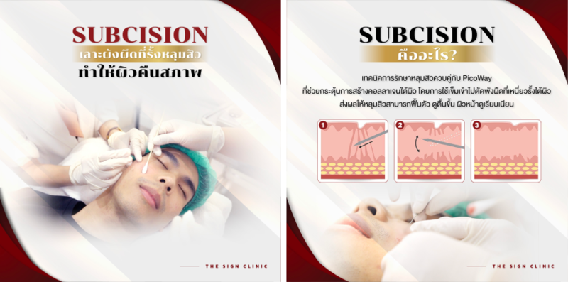 PicoWay Acne Scar และ Subcision เซาะพังผืดใต้หลุมสิว ตอบครบทุกคำถามโดยแพทย์ผู้เชี่ยวชาญ